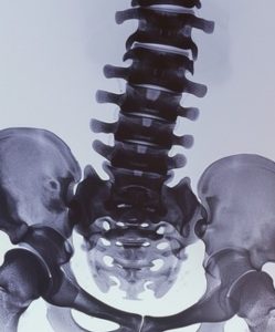 Management of Sciatic Scoliotic List in Lumbar Disc Herniation: Physical Therapy Approaches and ...